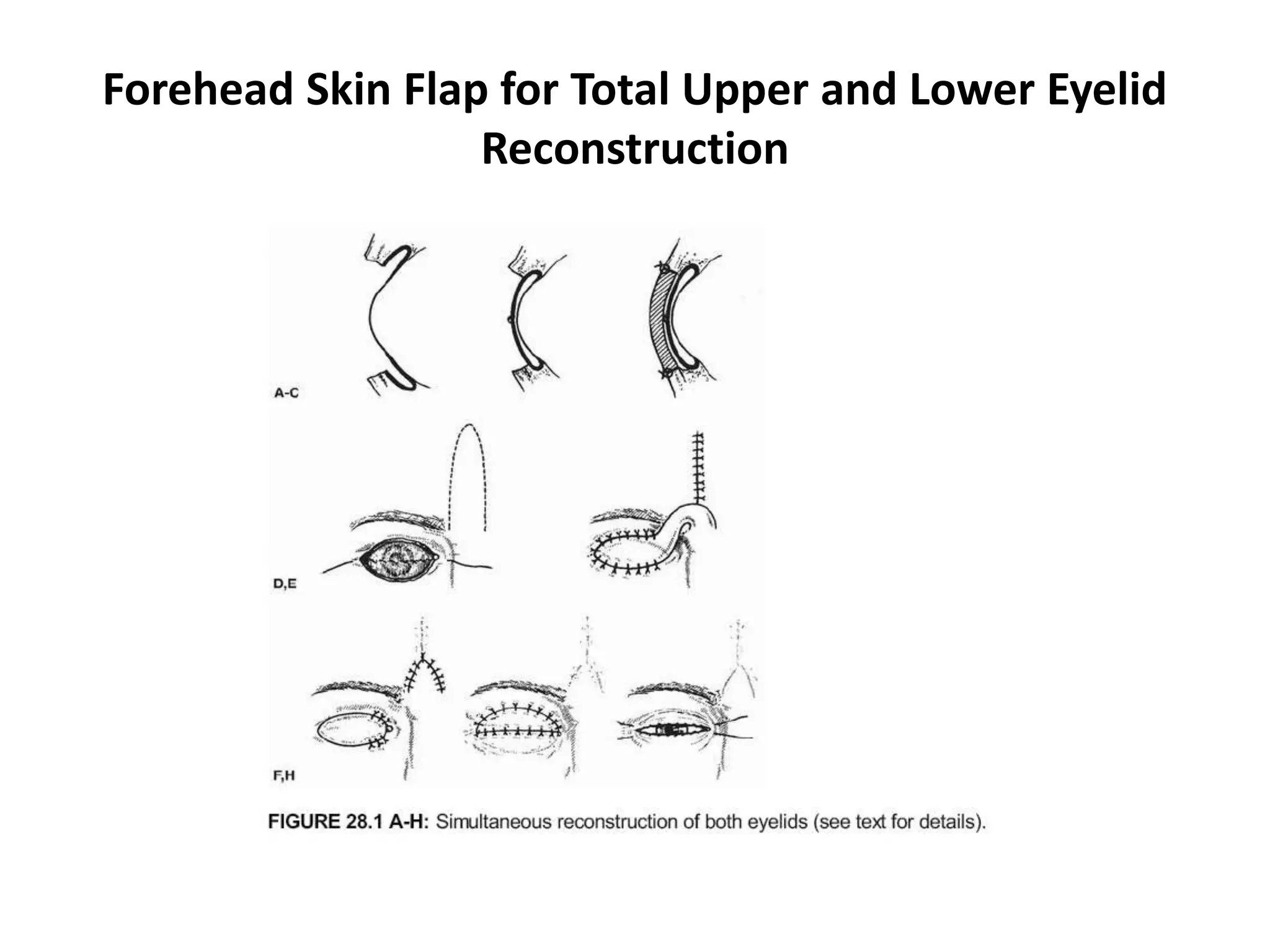 Eyelid reconstruction | PPTX