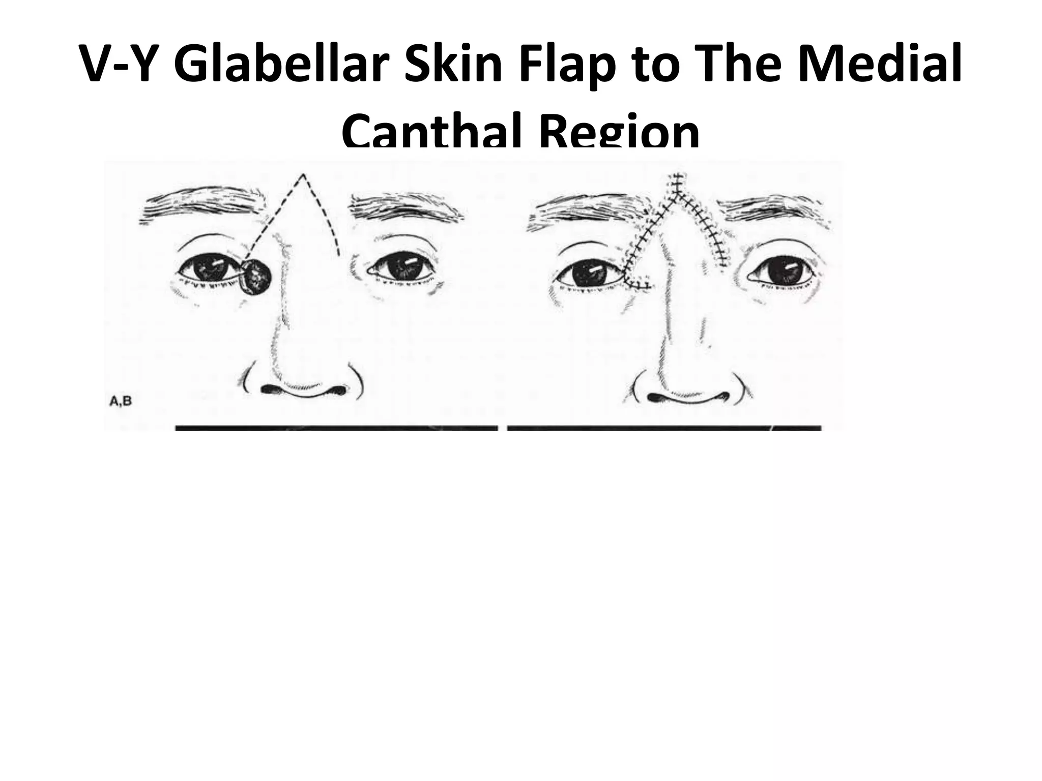 Eyelid reconstruction | PPTX