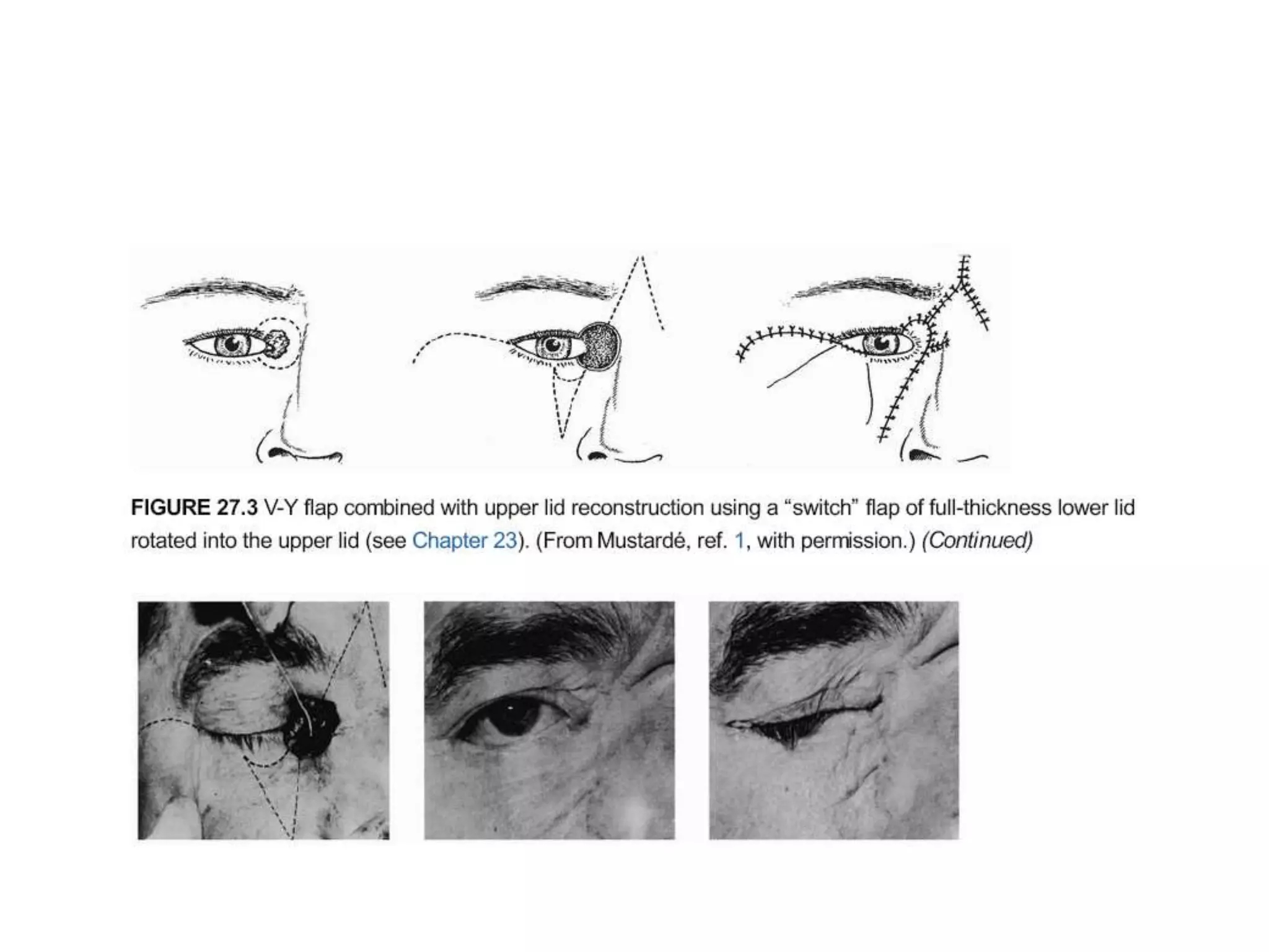 Eyelid reconstruction | PPTX