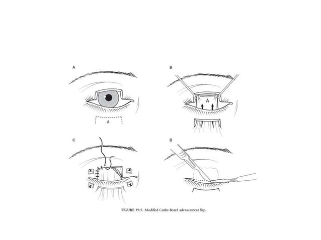 Eyelid reconstruction | PPTX