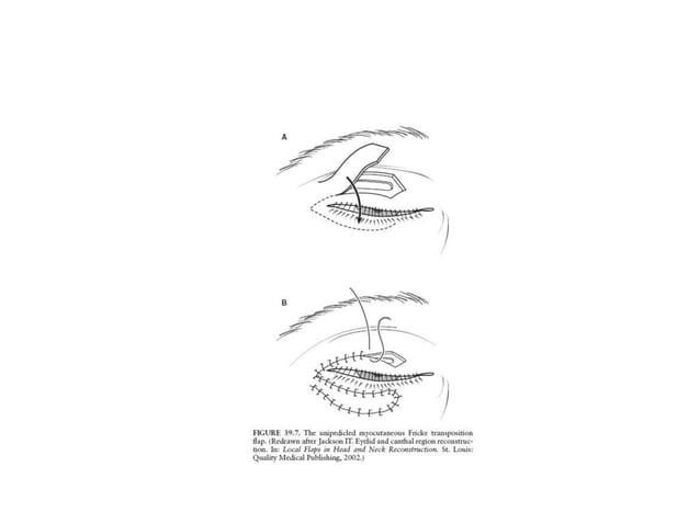 Eyelid reconstruction | PPTX