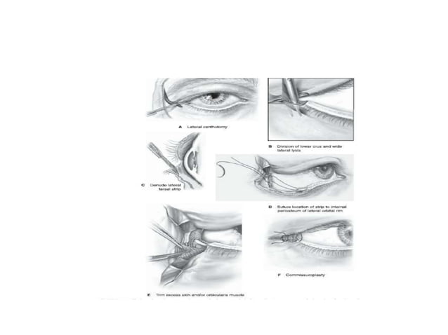 Eyelid reconstruction | PPTX