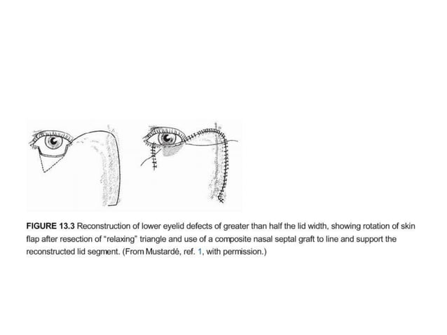 Eyelid reconstruction | PPTX