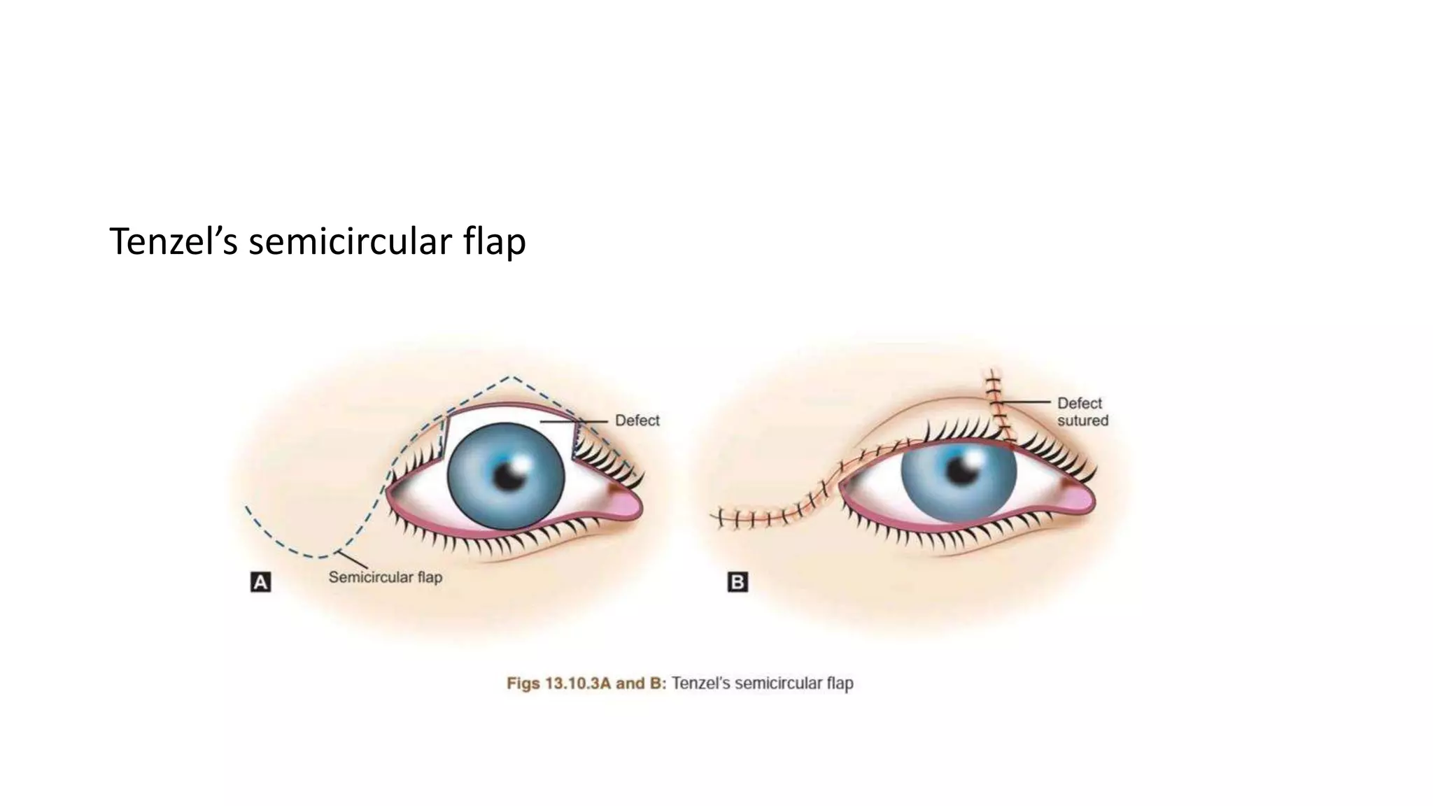 EYELID RECONSTRUCTION.pptx