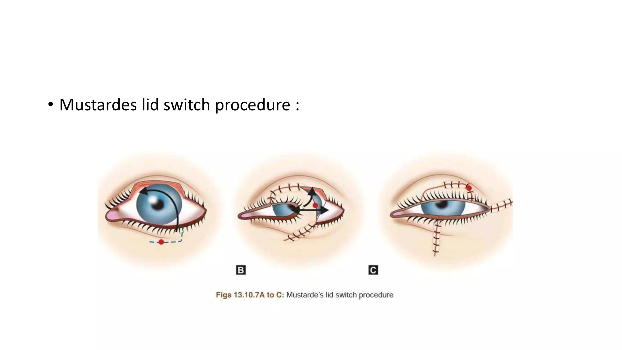 EYELID RECONSTRUCTION.pptx