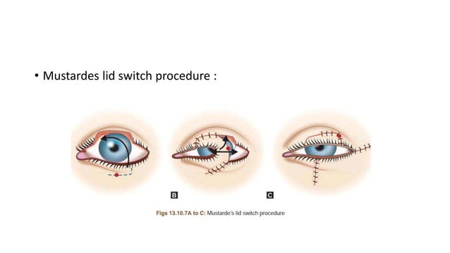 EYELID RECONSTRUCTION.pptx | Eye and Vision Conditions | Diseases and ...