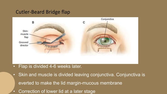 Eye lid reconstruction plastic surgery presentation | PPT