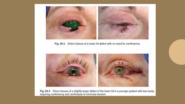 Eye lid reconstruction plastic surgery presentation | PPT