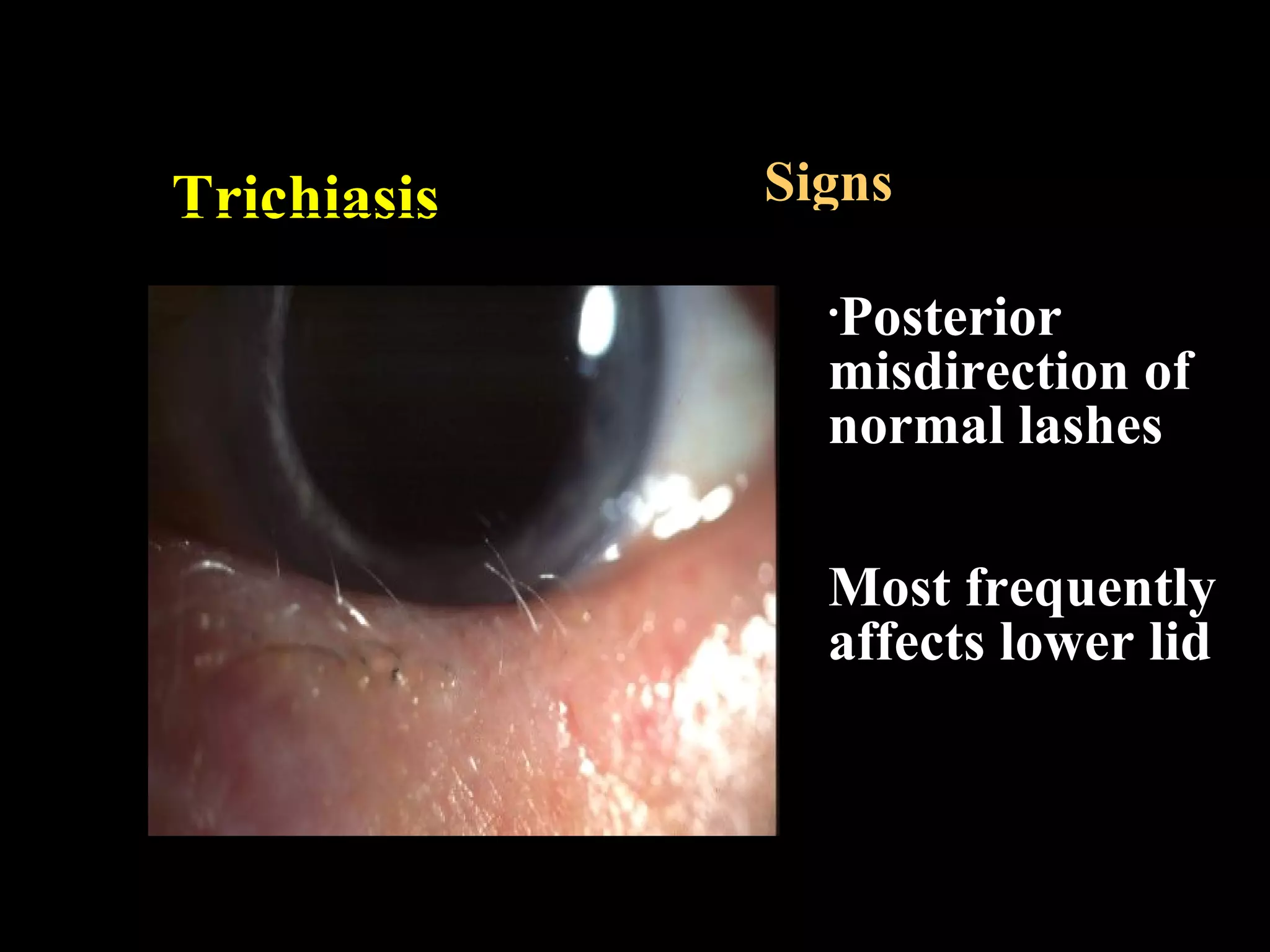 Eye lids disorders of lashes | PPT | Eye and Vision Conditions ...