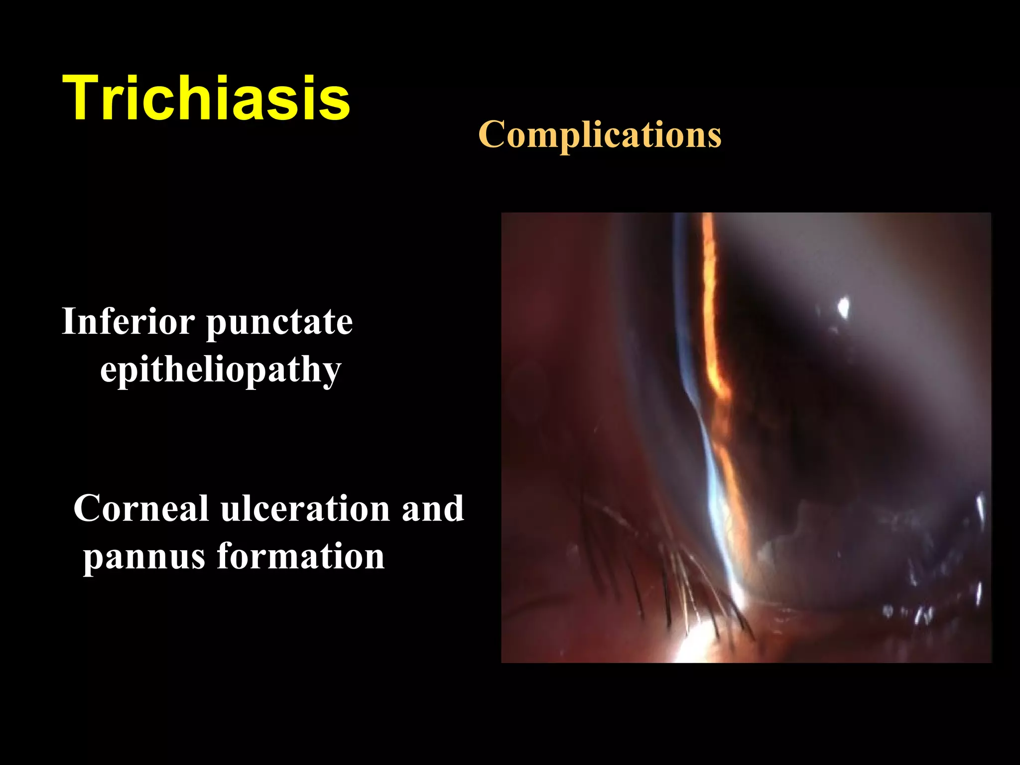 Eye lids disorders of lashes | PPT | Eye and Vision Conditions ...