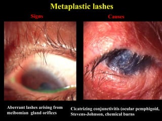 Eye lids disorders of lashes | PPT | Eye and Vision Conditions ...