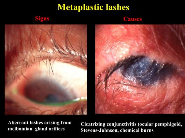 Eye lids disorders of lashes | PPT | Eye and Vision Conditions ...