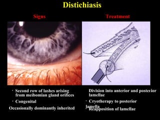 Eye lids disorders of lashes | PPT | Eye and Vision Conditions ...