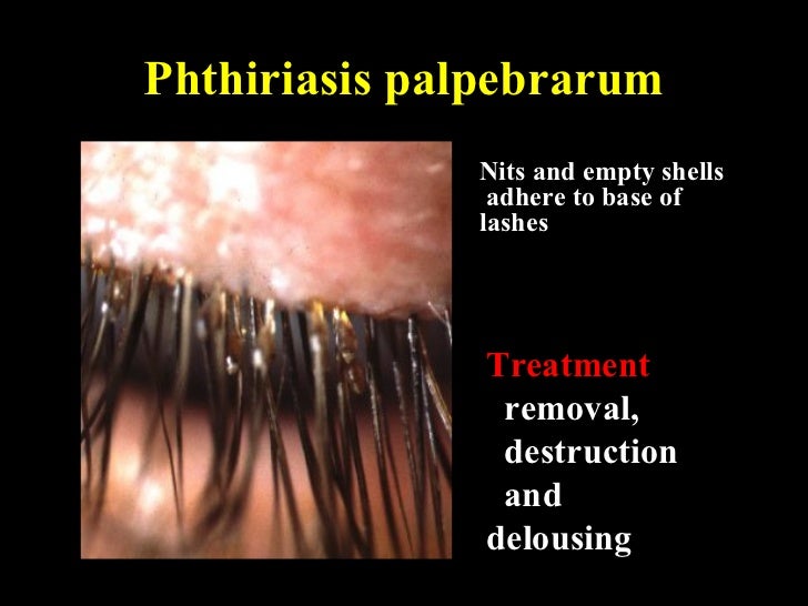 Eye lids disorders of lashes