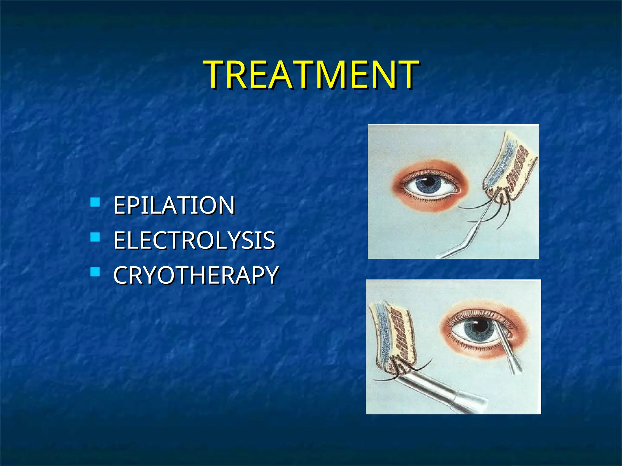 EYELIDS DISORDERS for pg studets powerpoint | PPT