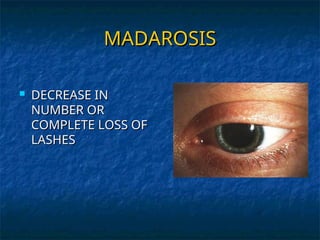 EYELIDS DISORDERS for pg studets powerpoint | PPT