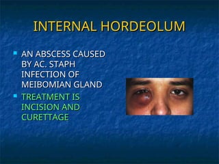 EYELIDS DISORDERS for pg studets powerpoint | PPT