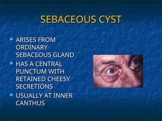 EYELIDS DISORDERS for pg studets powerpoint | PPT