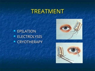 EYELIDS DISORDERS for pg studets powerpoint | PPT