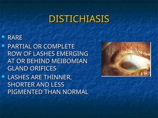 EYELIDS DISORDERS for pg studets powerpoint | PPT