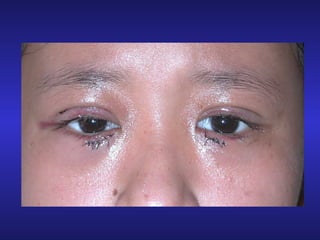 Cleft Eyelid