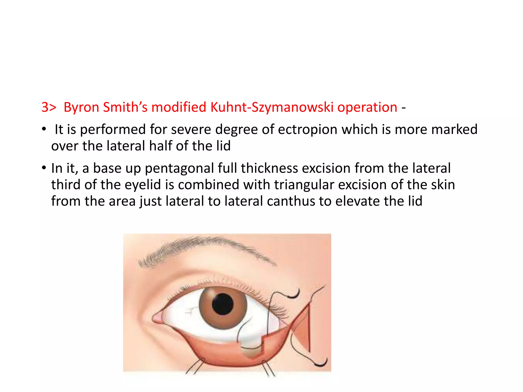 Eyelid surgery | PPTX