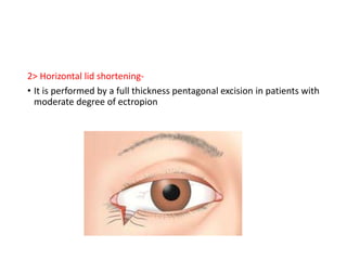 Eyelid surgery | PPTX