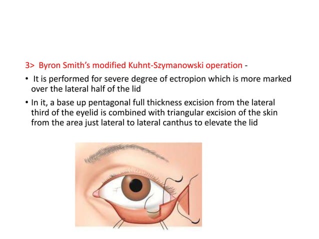 Eyelid surgery | PPTX