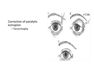 Eyelid surgery | PPTX