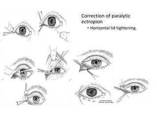 Eyelid surgery | PPTX