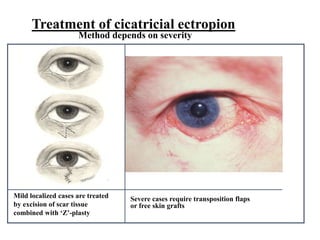 Eyelid surgery | PPTX