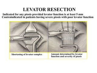 Eyelid surgery | PPTX