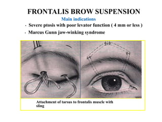 Eyelid surgery | PPTX