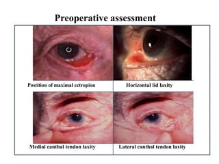 Eyelid surgery | PPTX
