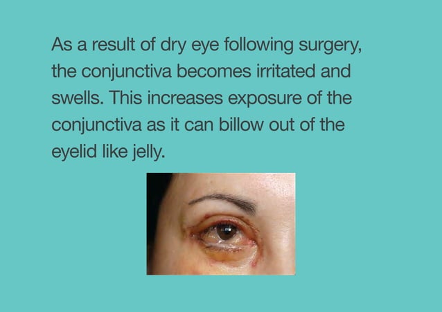 Eyelid surgery: What is chemosis and how to treat it | PPT