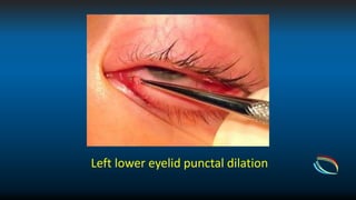 Eyelid Trauma .pptx