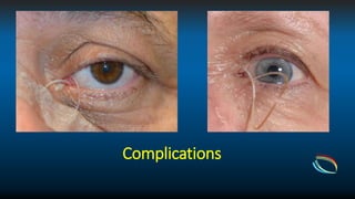 Eyelid Trauma .pptx
