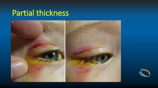 Eyelid Trauma .pptx
