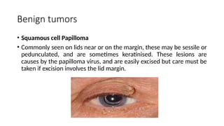 eye lid tumors.pptx . . . . . . . . | PPTX