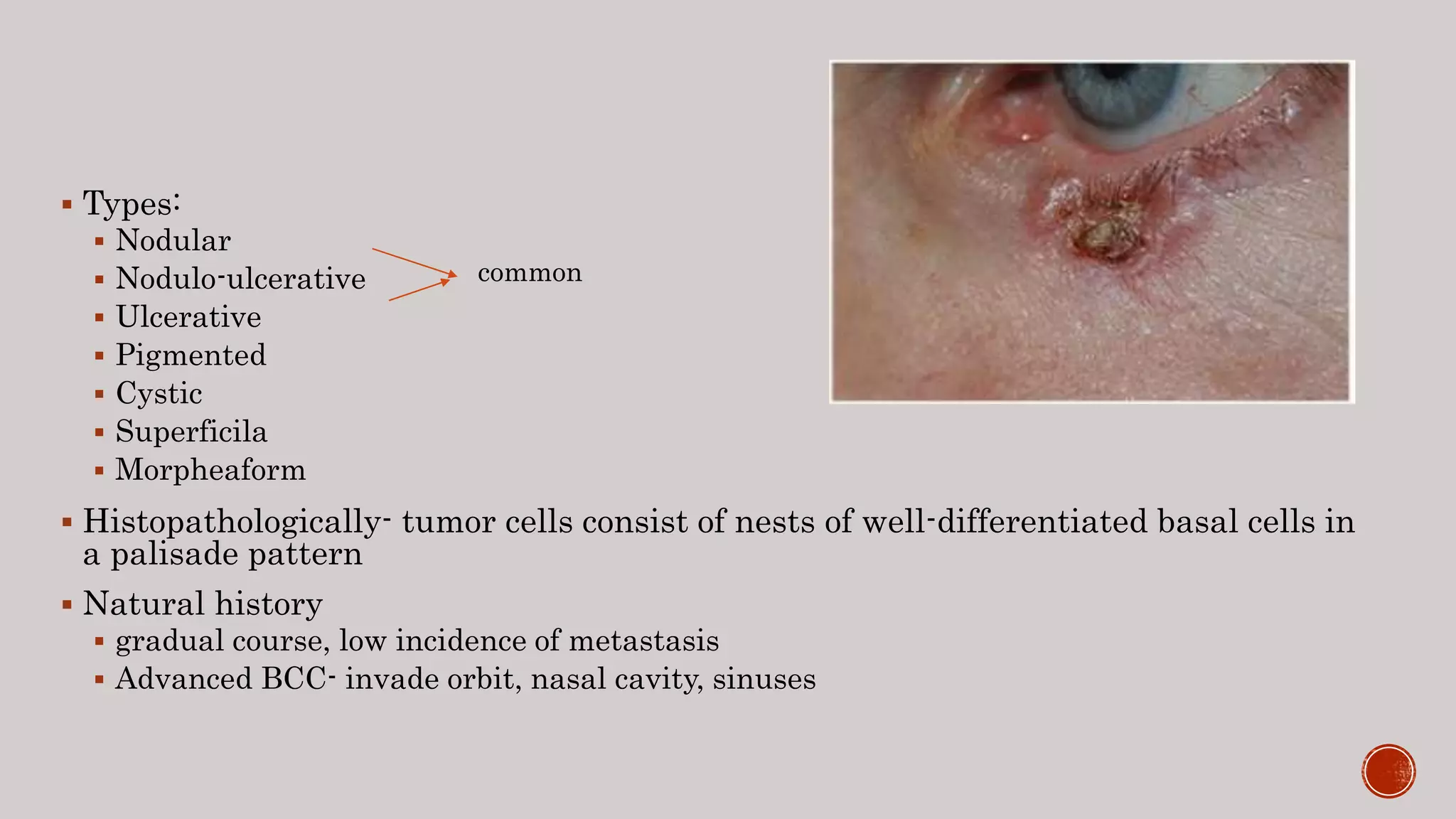 Eyelid tumors | PPTX