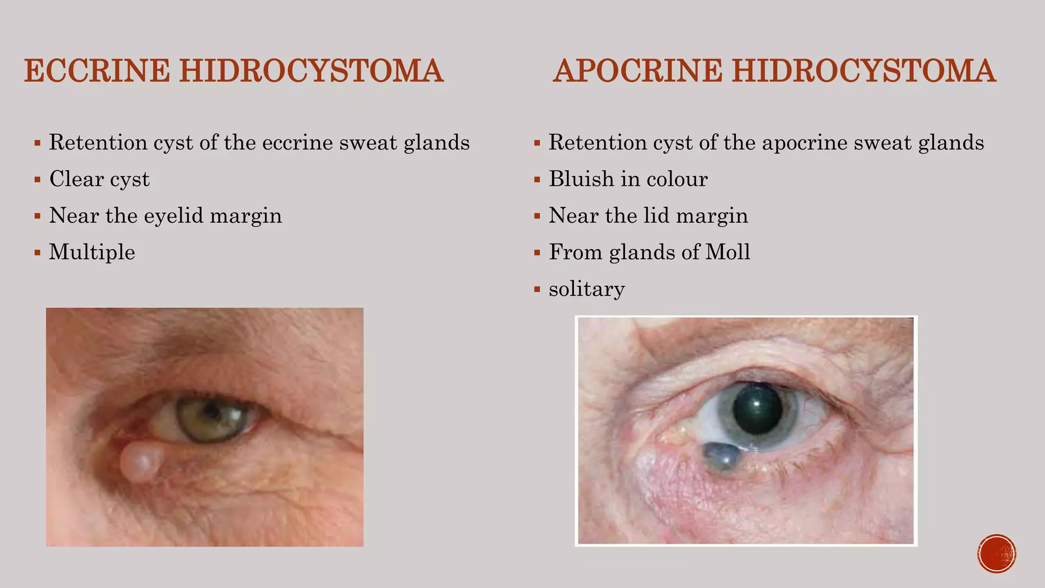 Eyelid tumors | PPTX