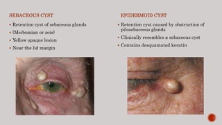 Eyelid tumors | PPTX