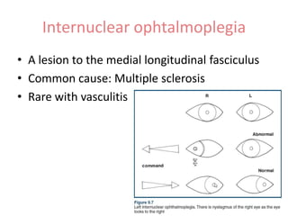 Eye movements examination | PPTX | Eye and Vision Conditions | Diseases ...