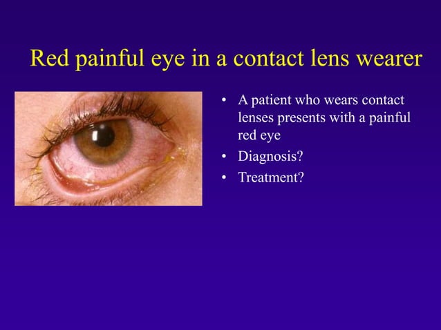 Eye Ophthalmologic Emergencies.......... | PPT | Eye and Vision ...