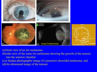 Eye plaque Therapy - PS Iyer Oration Talk Mumbai(1).pdf