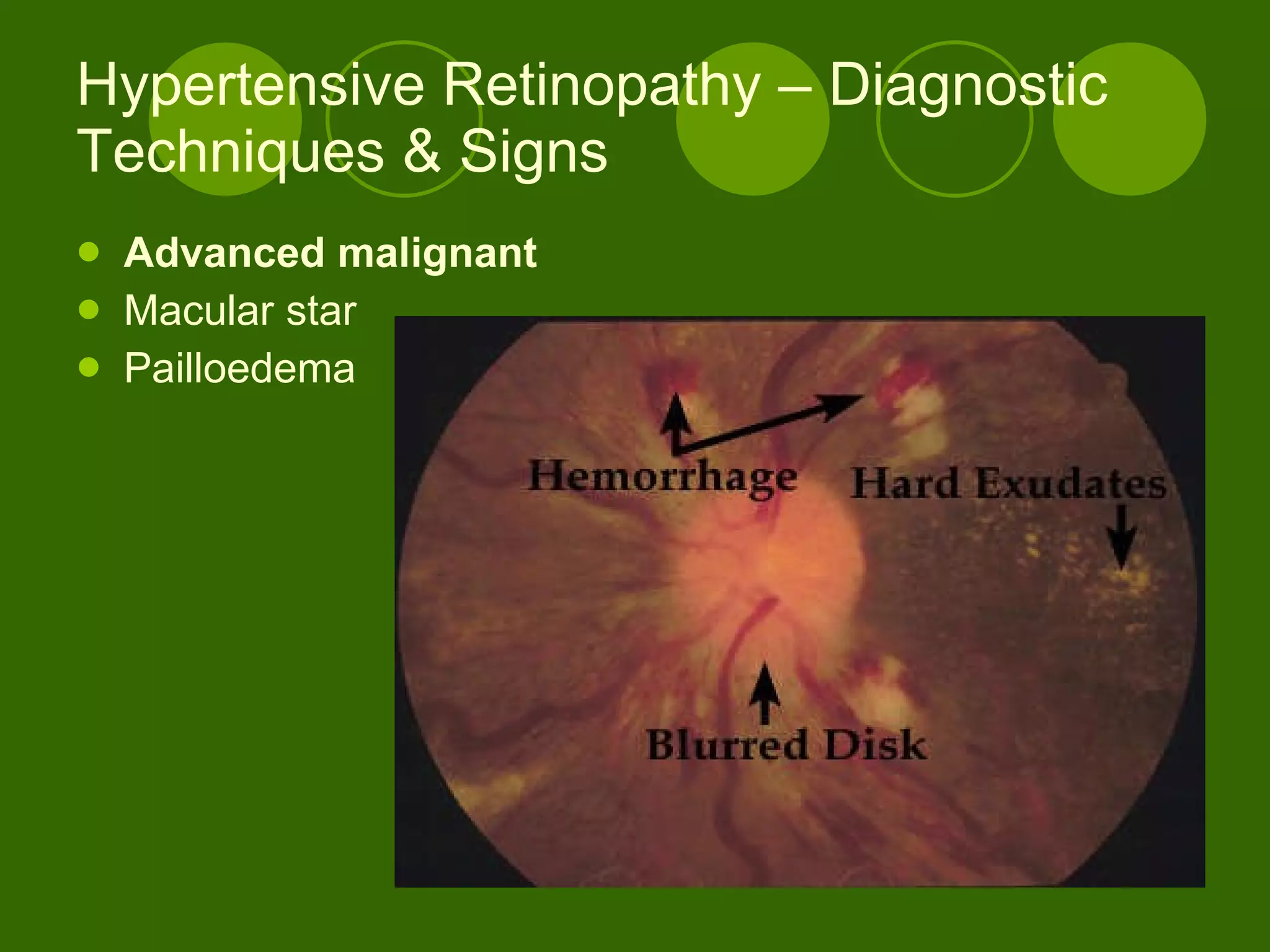 Hypertensive Retinopathy | PPT