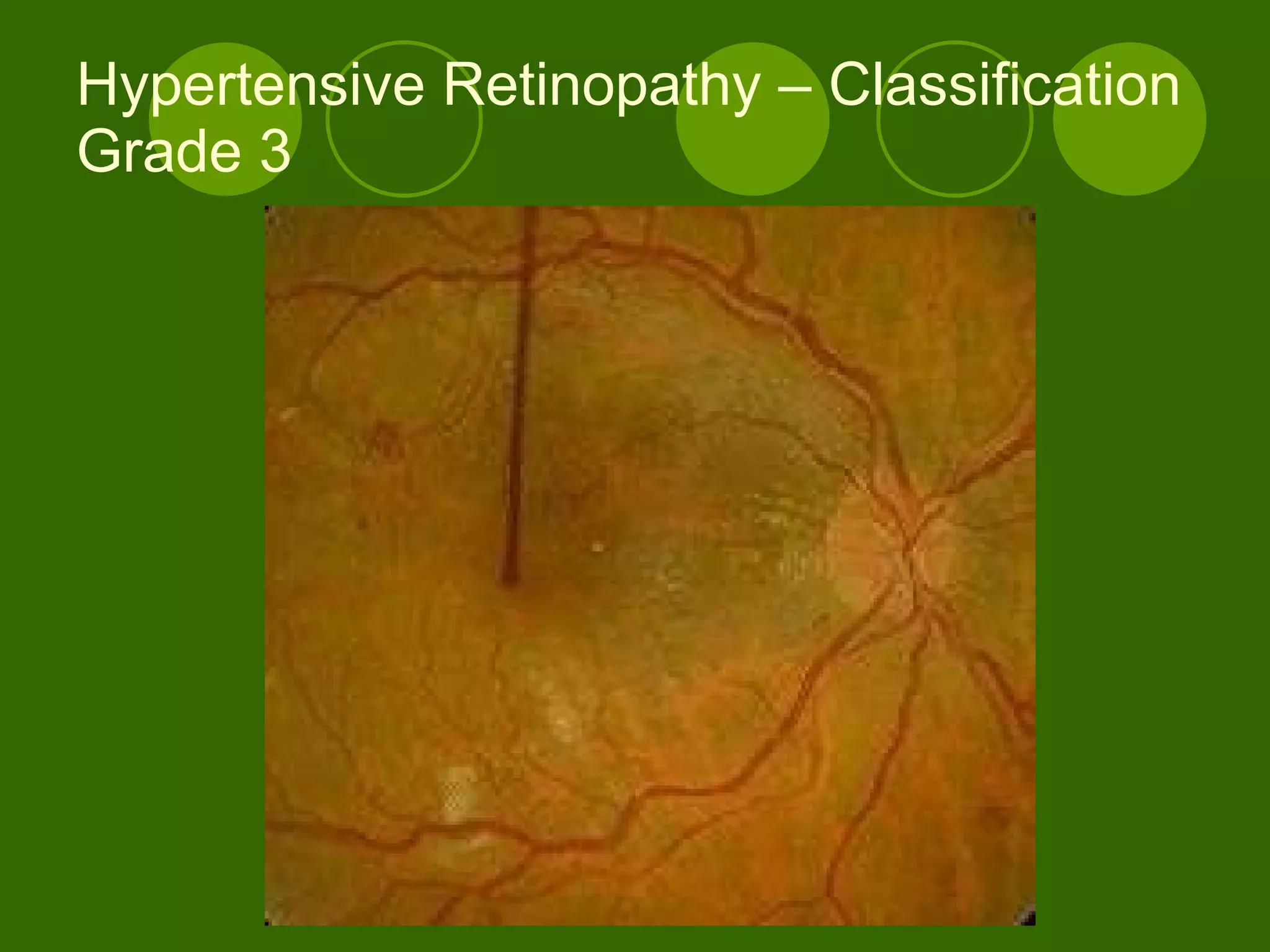 Hypertensive Retinopathy | PPT