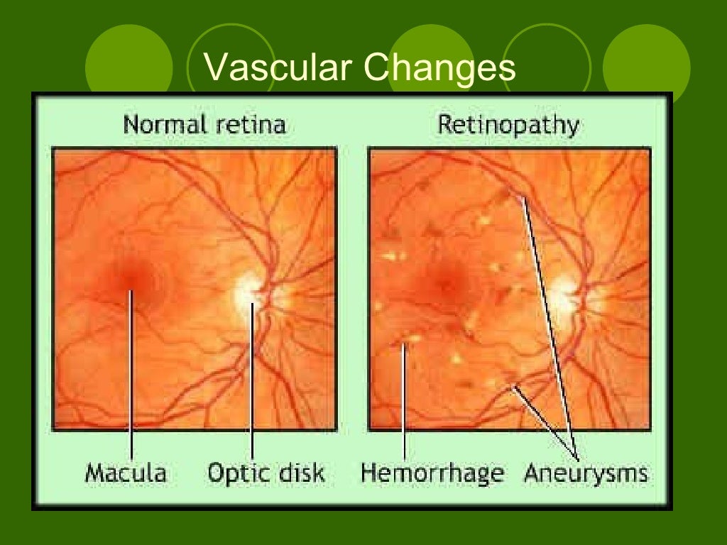 Hypertensive Retinopathy