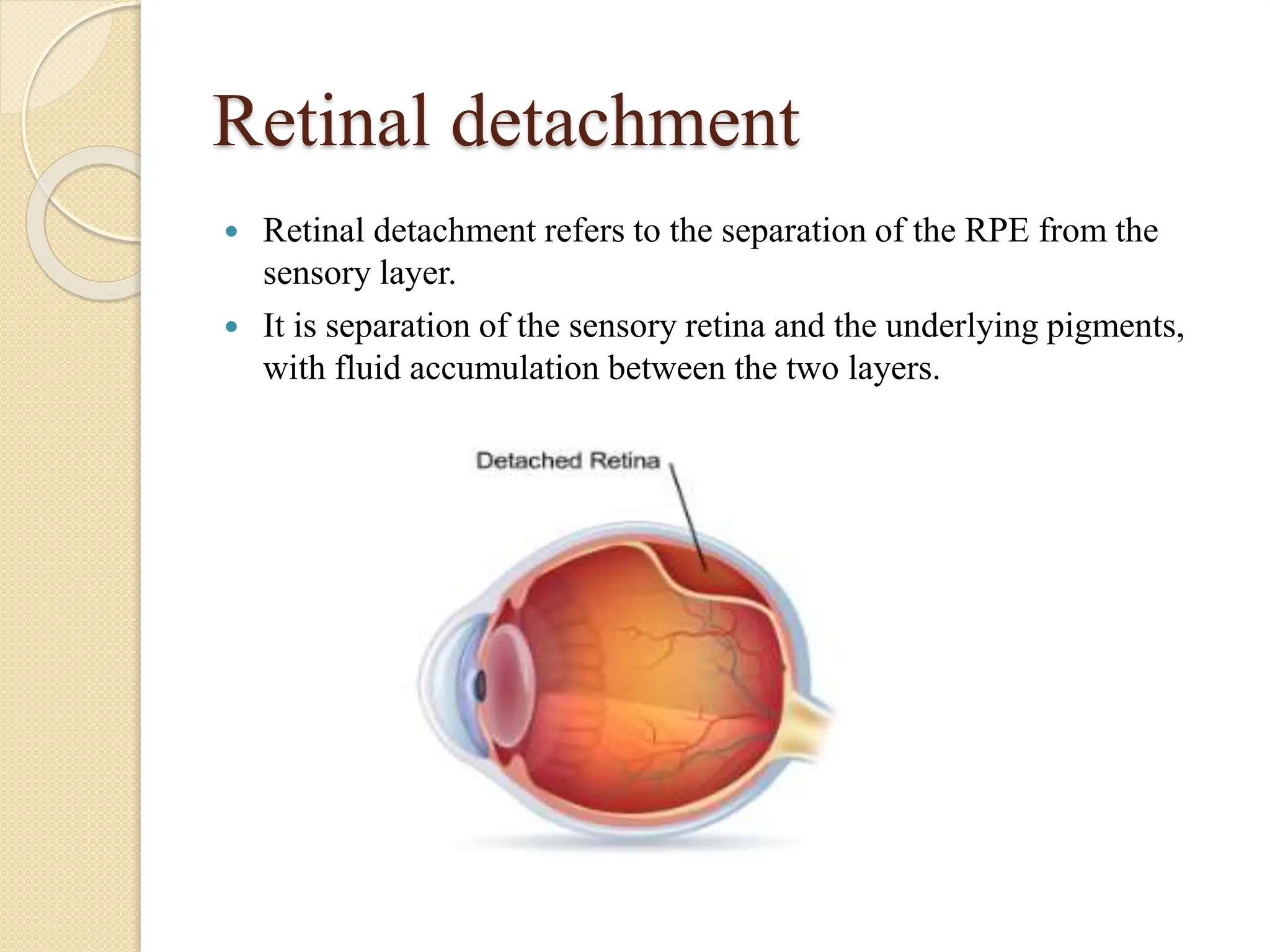 eye retinal detachment-1.pptx