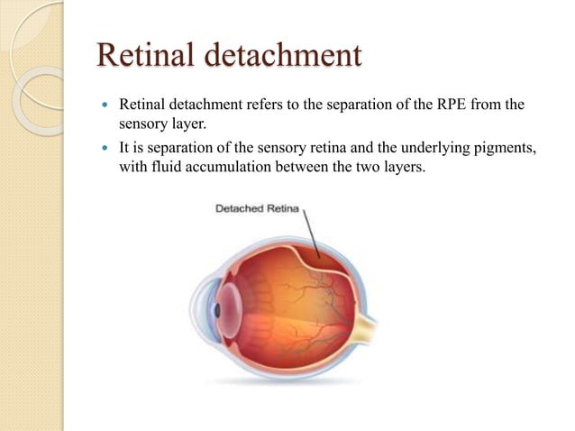 eye retinal detachment-1.pptx